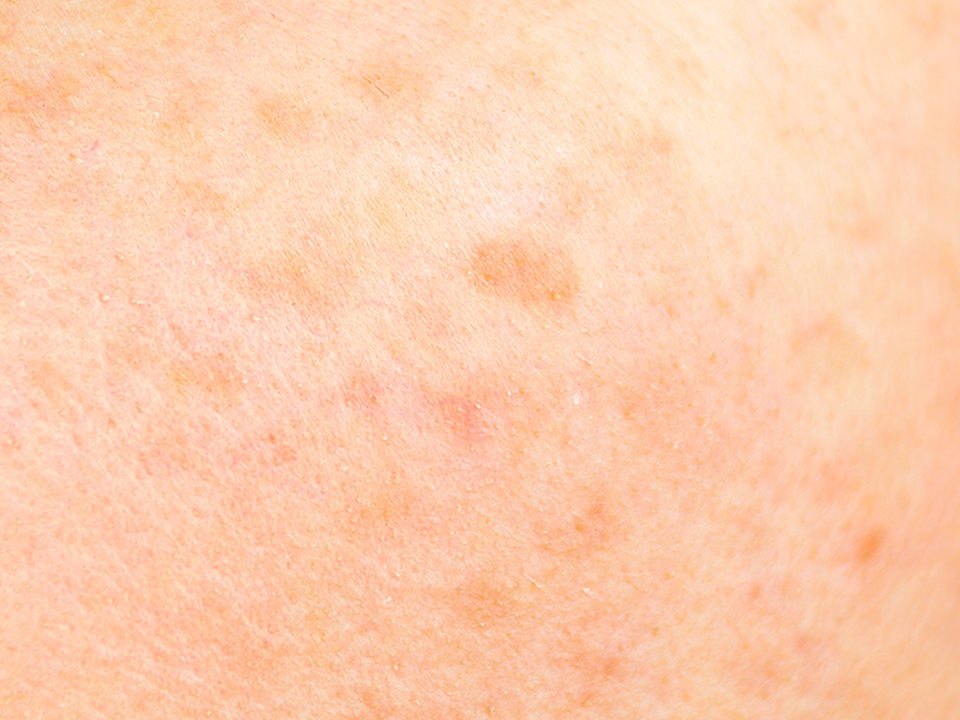 Hyperpigmentierung – Alles über Pigmentflecken und wie Du sie loswirst │ mit BABOR